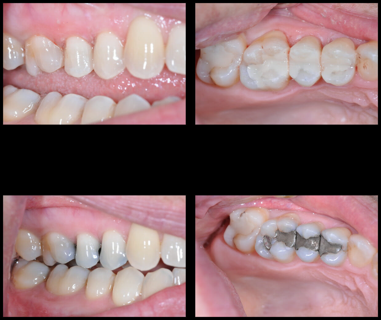 Tooth Filling Before And After